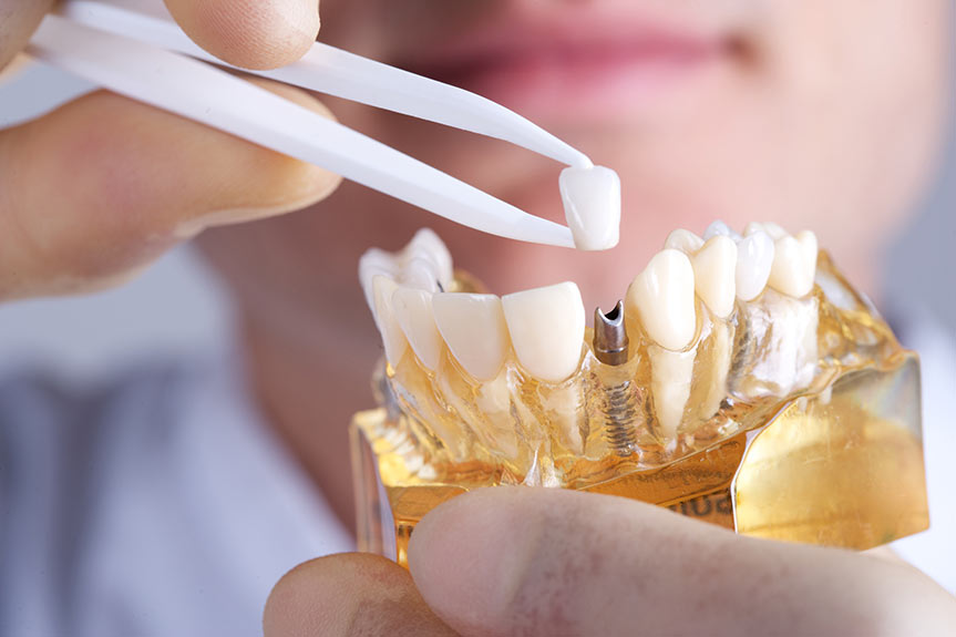 Potential Risks and Complications of Dental Implants - Richannel